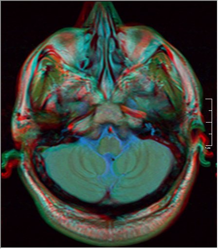 Nevit's blog: Motion atrifacts, Color Brain MRI