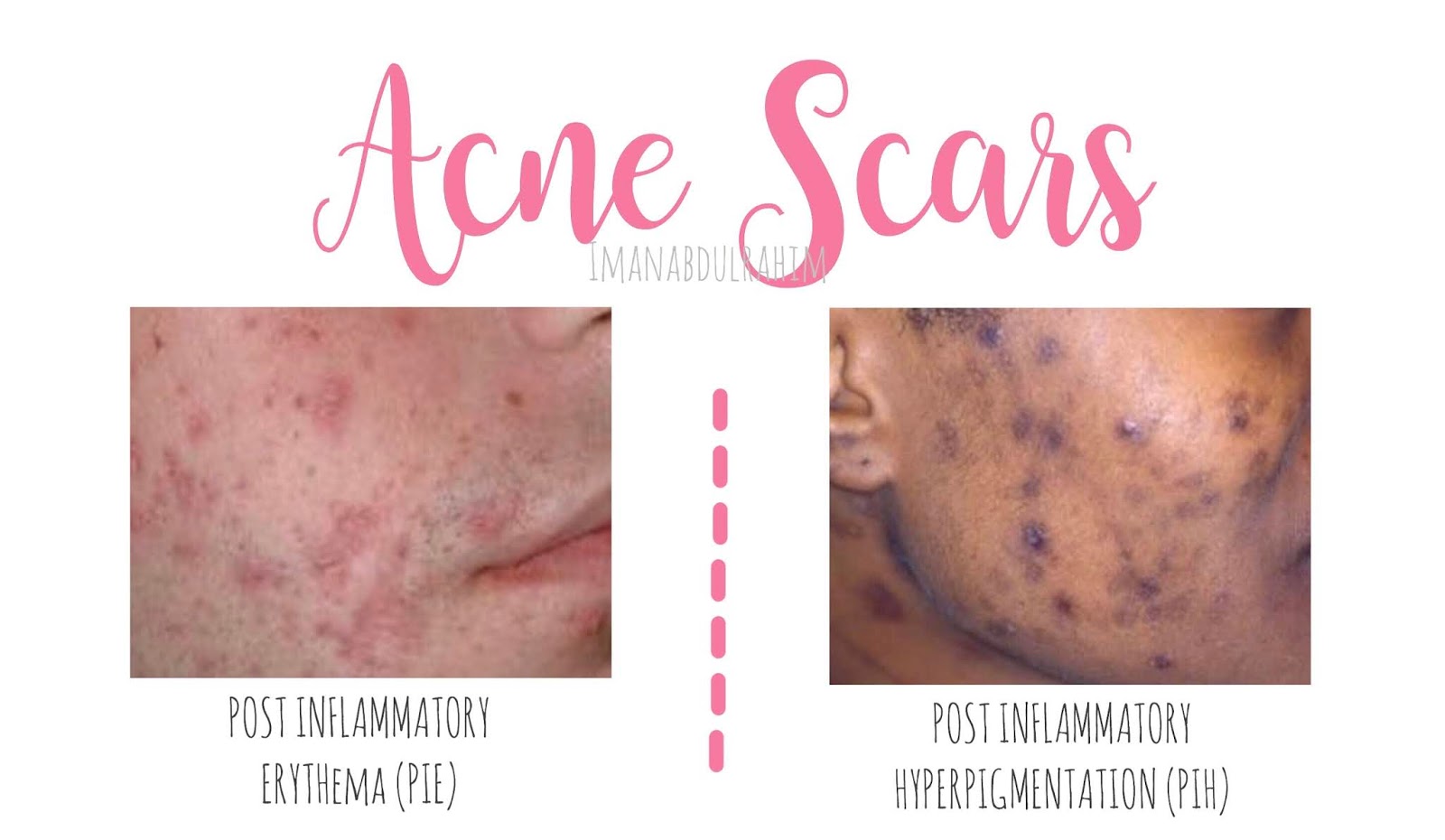 How to reduce acne scars? ~ IMAN ABDUL RAHIM