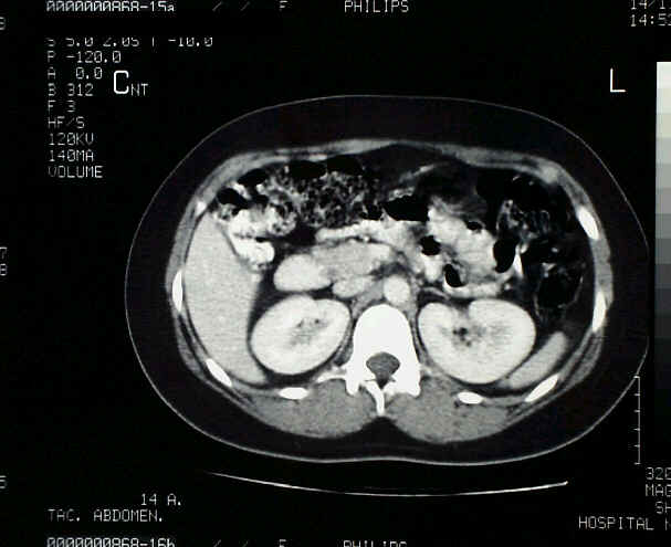 Ciencias del Mundo Conteporáneo: Tomografía Axial Computarizada (TAC)