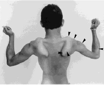 Clinical Neurology: Discovering neurological signs: poly hill sign in ...