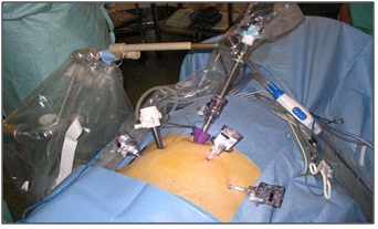 Instrumentación quirúrgica: Laparoscopia