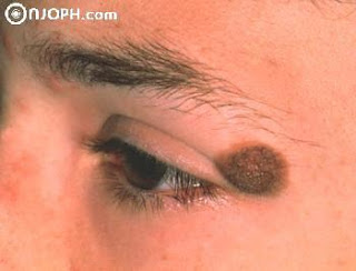 Medicina para todos.: Lesiones de la piel