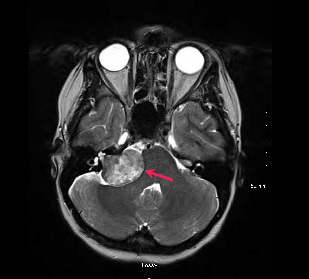 Actor Mark Ruffalo Had Surgery to Remove Acoustic Neuroma | Fauquier ...