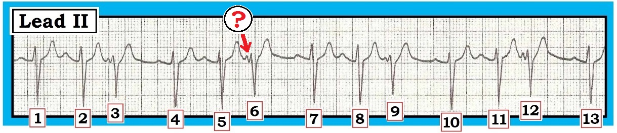 ECG Interpretation: ECG Interpretation Review #67 (PAC – PVC – 12 Leads ...