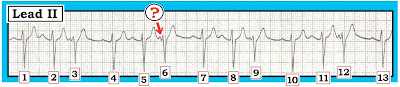 ECG Interpretation: ECG Interpretation Review #67 (PAC – PVC – 12 Leads ...