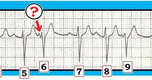 Ecg Interpretation Ecg Interpretation Review 67 Pac Pvc 12 Leads Better Than One