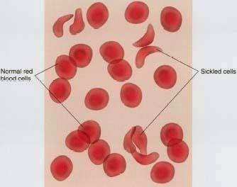 Gotham City Paramedic: Let's Shine the Bat Signal on Sickle Cell Anemia