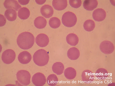 FICHERO DE HEMATOLOGIA: ALTERACIONES ERITROCITARIAS