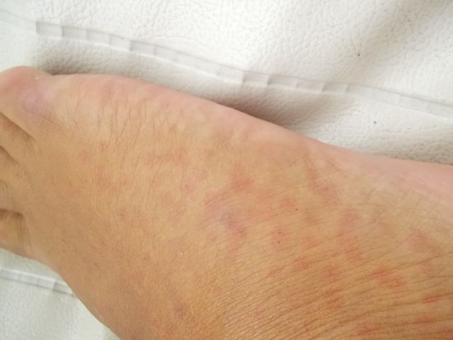 Bug Treatment No See Um Bug Treatment