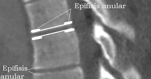 El Baúl Radiológico: ENFERMEDAD DE SCHEUERMANN (DORSALGIA JUVENIL ...