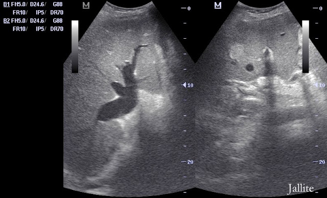 Calculo Conducto Cistico