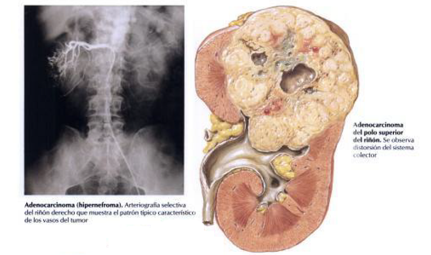 TUMORES RENALES | Un paseo por la ciencia