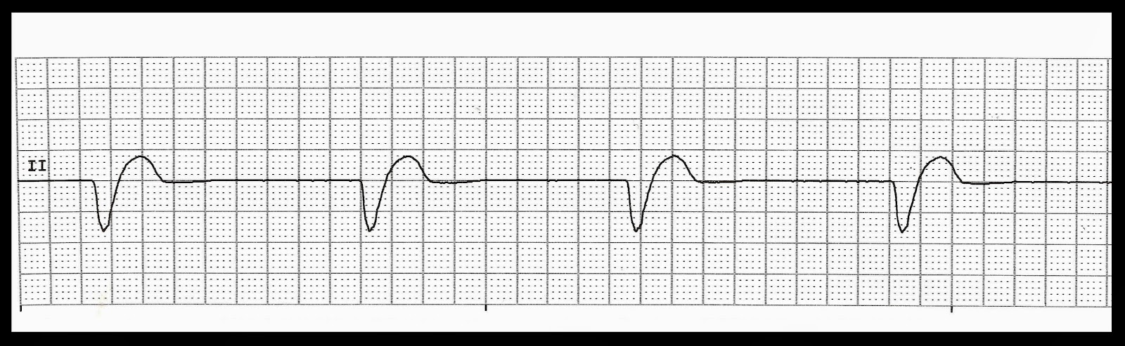 EKG Rhythm Quiz 268