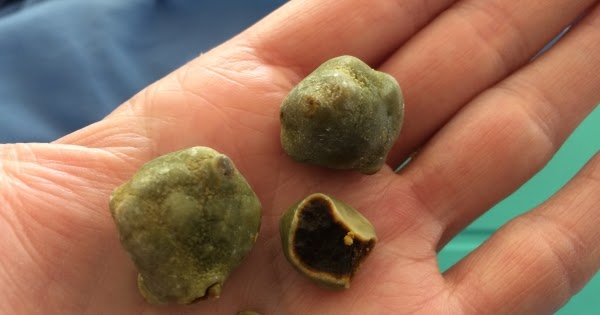 Kijk even * * *: Roestende galstenen