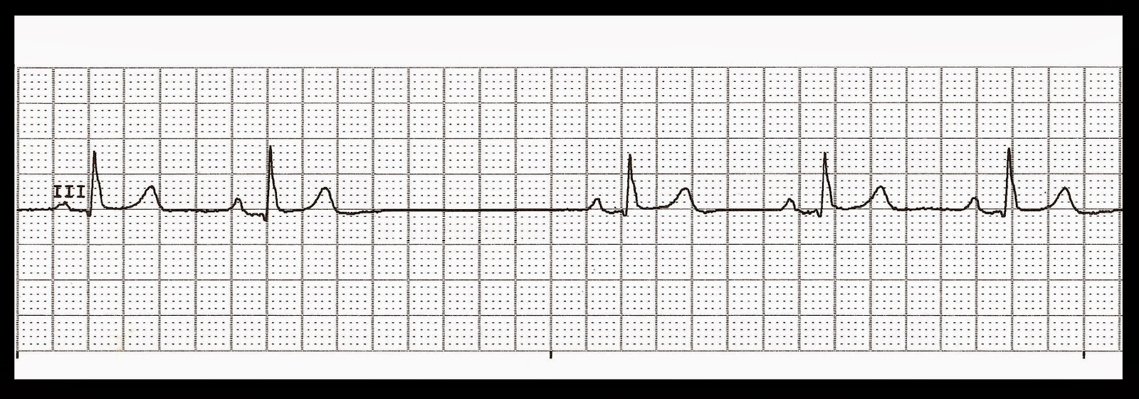 Practice EKG Strips 376