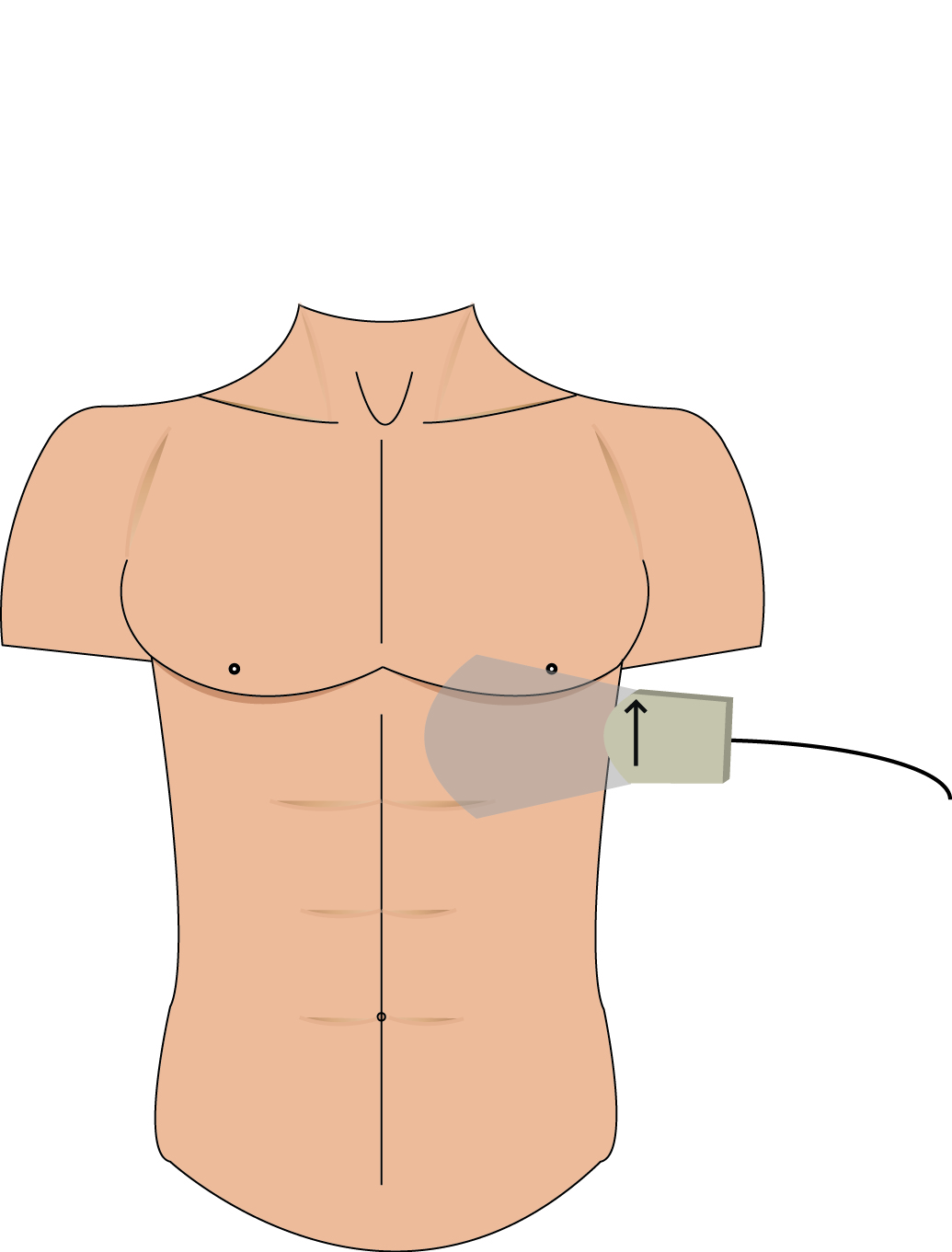 The "Perisplenic View" of the FAST ~ Ultrasound Cases Info