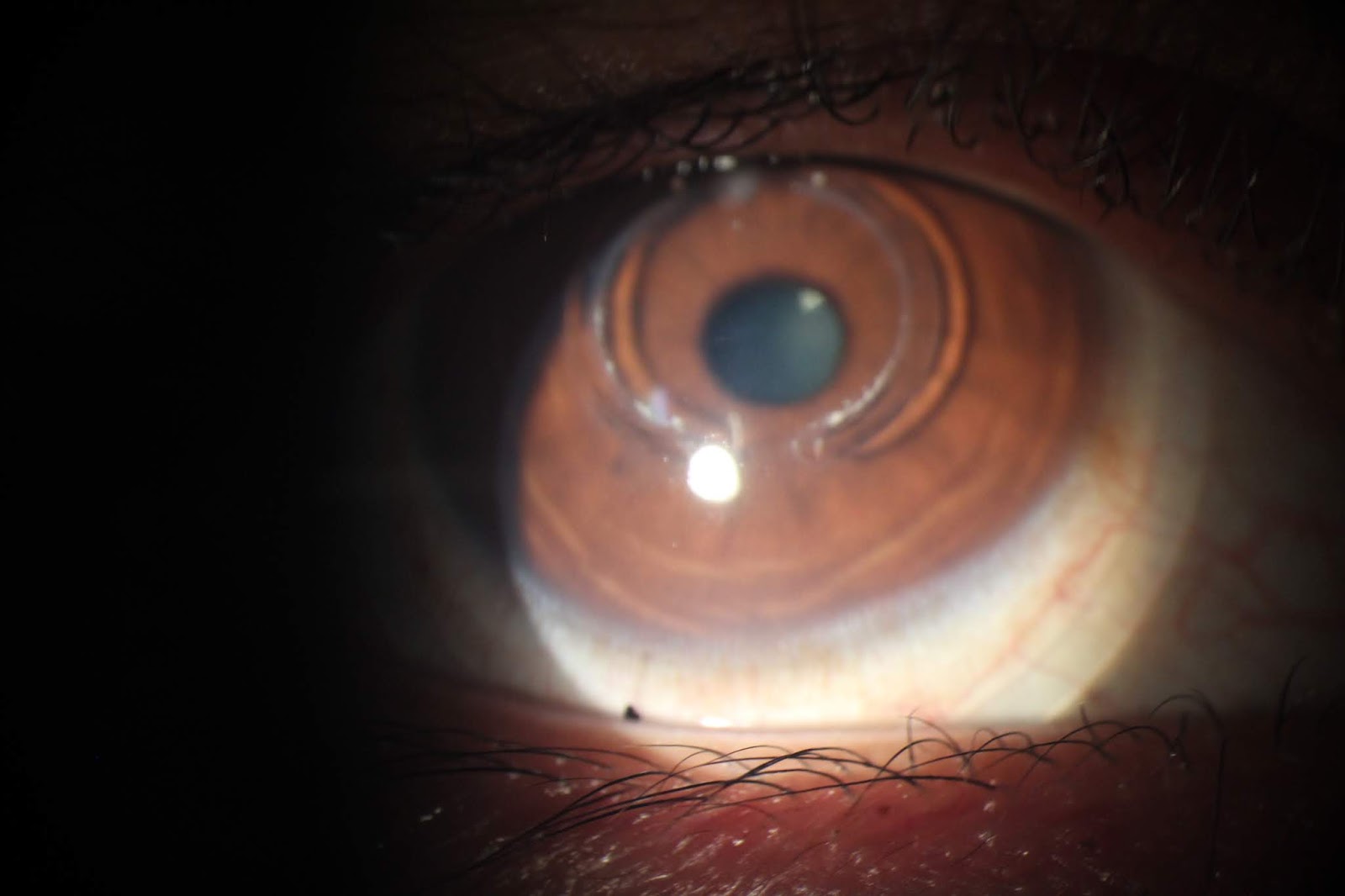 What to do when you have keratoconus?
