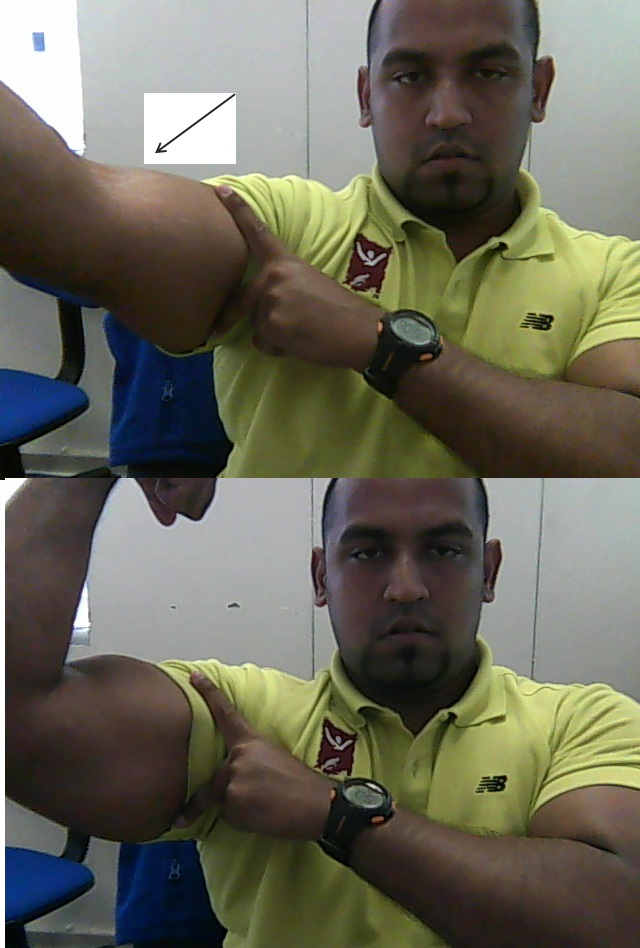 Stretch marks and the bodybuilder. By Vic Goyaram ~ BODYBUILDING ...