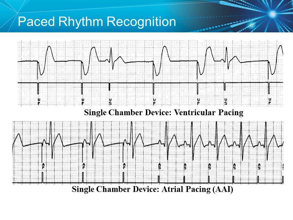 CVT Mohd Farid: Pacemaker Follow Up Part I-Medtronic Academy