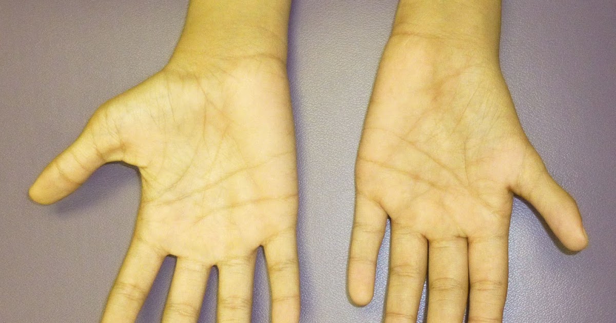 Small thumbs | Congenital Hand and Arm Differences