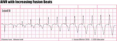 ECG Educator Blog : Accelerated Idioventricular Rhythm (AIVR)