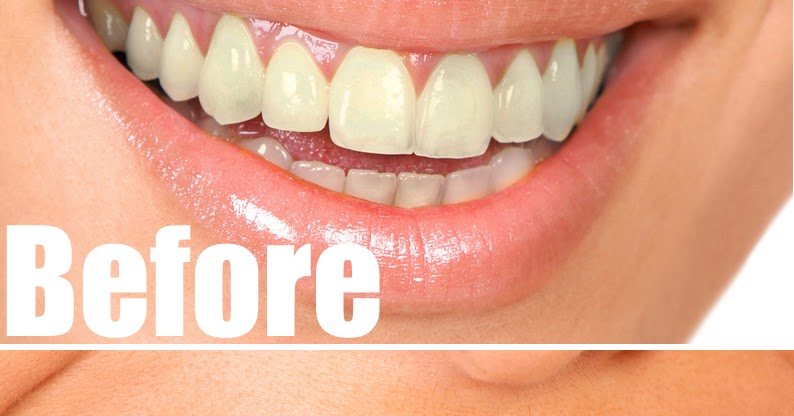 DIENTES BLANCOS CON RECETA CASERA