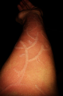 dermographic urticaria