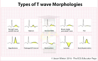 ECG Educator Blog : Types of T-waves