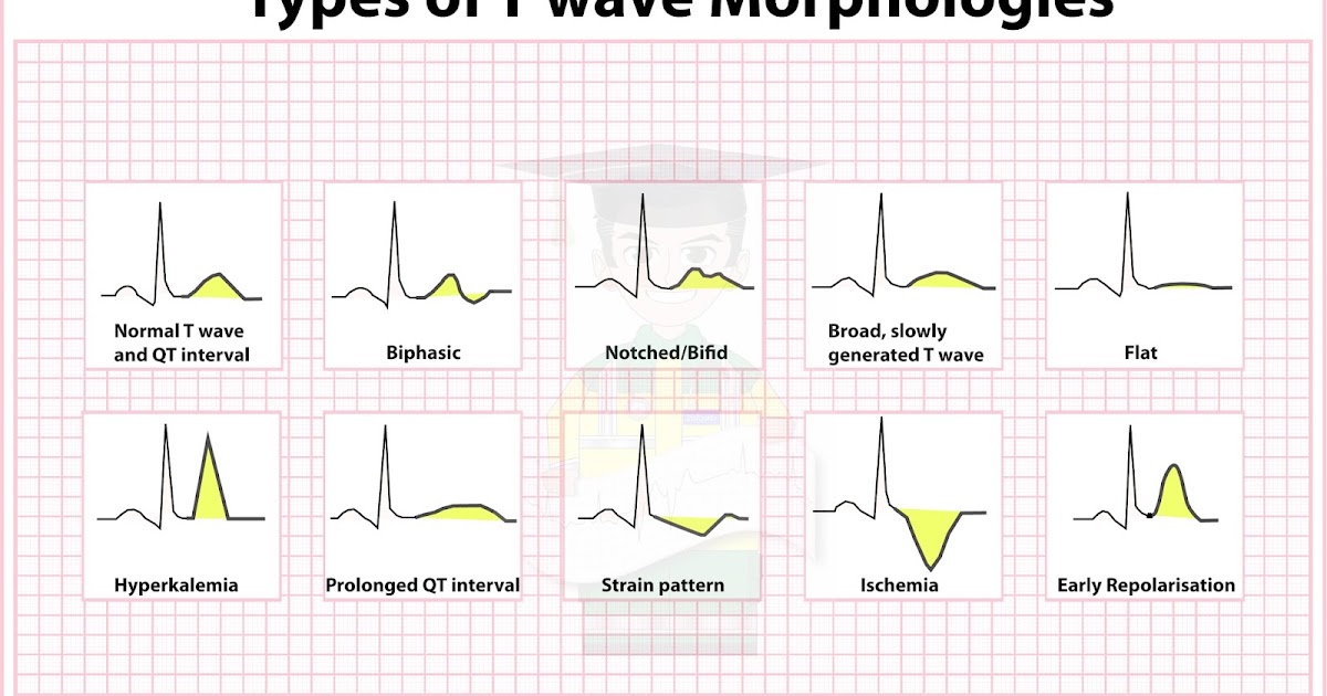 ECG Educator Blog : Types of T-waves