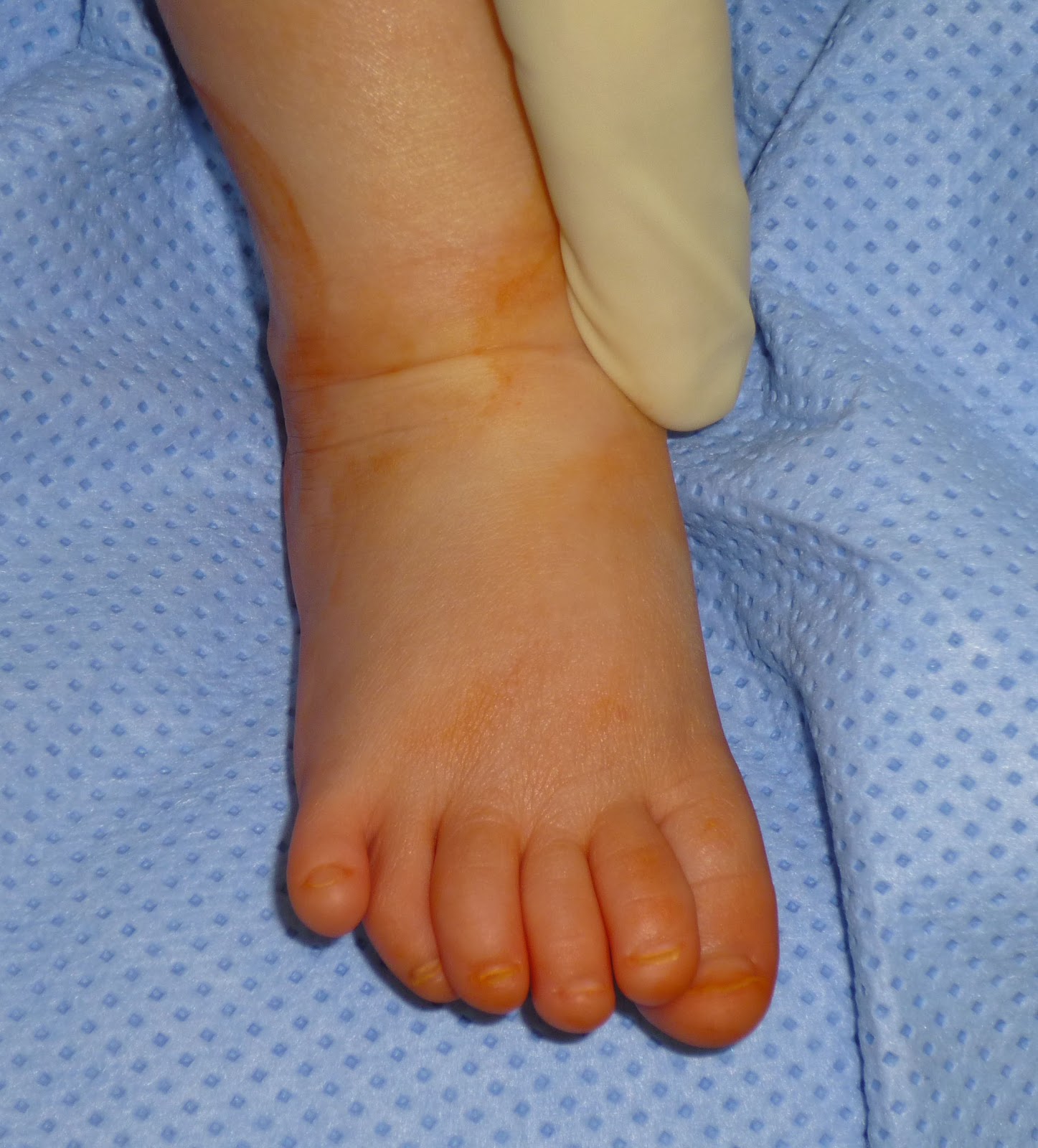 Extra Digits | Congenital Hand and Arm Differences | Washington ...