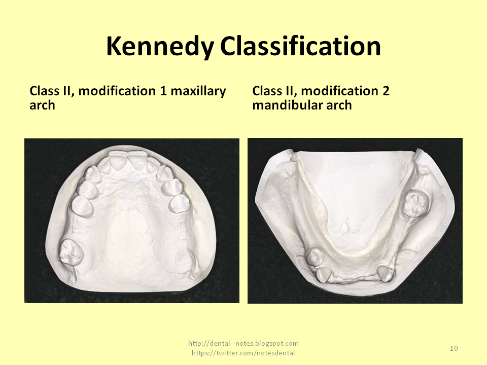 Dental Notes: Classification Of Partially Edentulous Arches NOTES