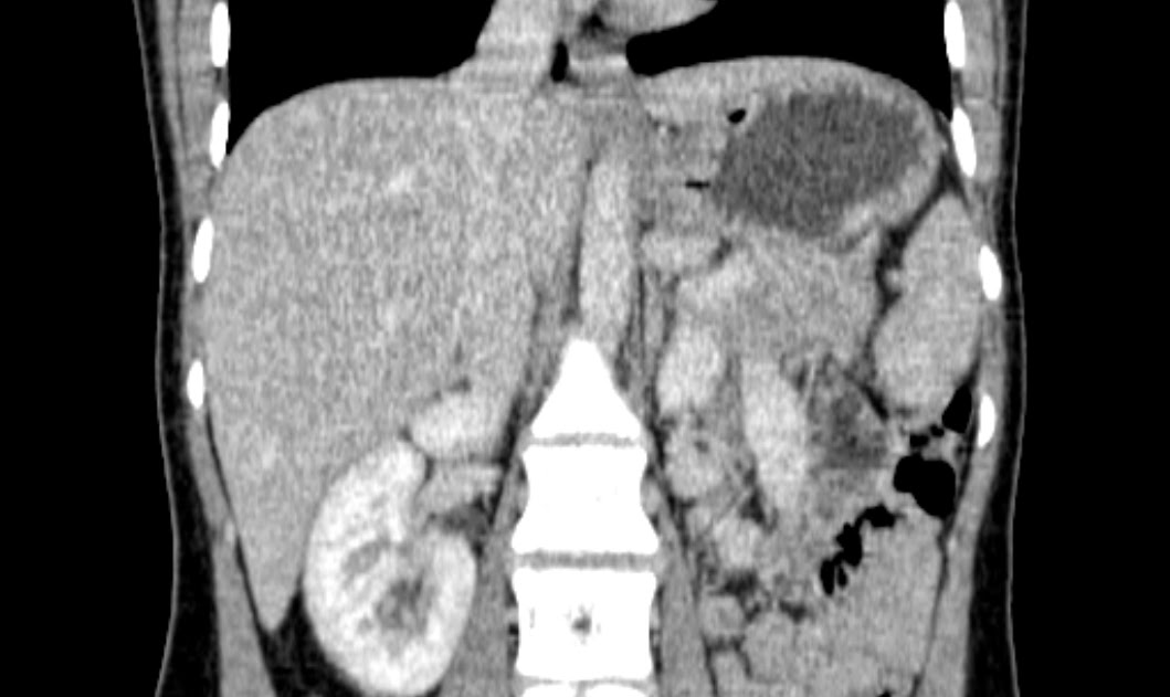 Ultimate Radiology : Pseudolesion : Papillary Process of Caudate Lobe