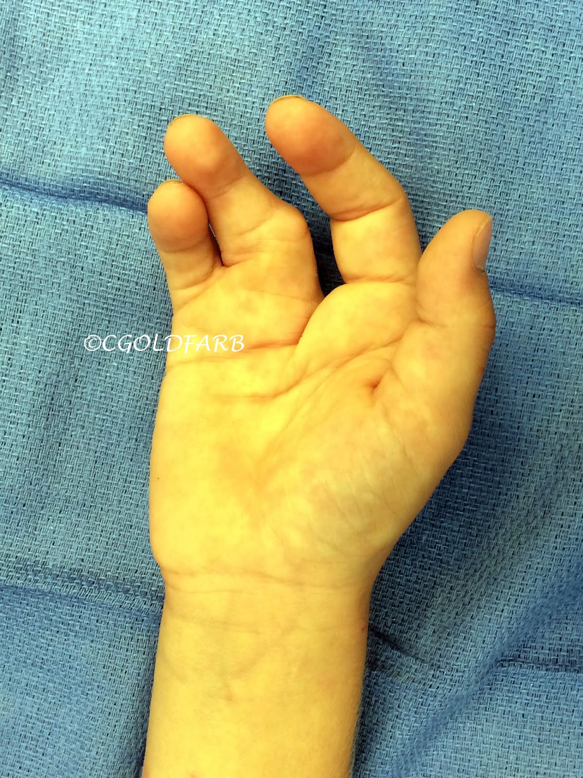 Cleft Hand Reconstruction | Congenital Hand and Arm Differences ...