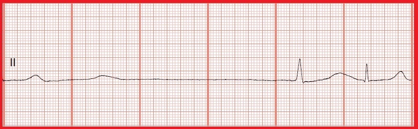 EKG Rhythm Strip Quiz 141
