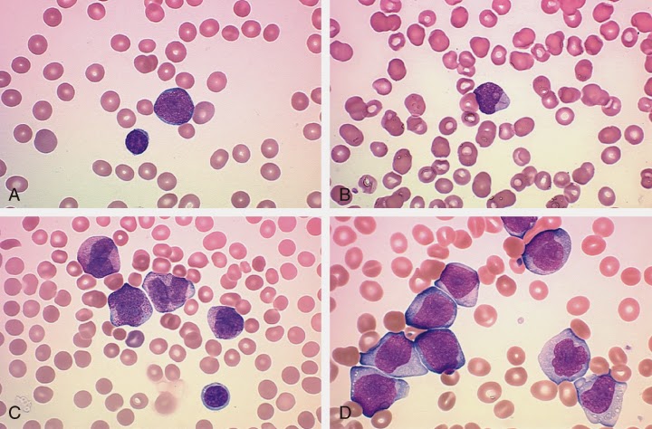 Discussing Acute Myeloid Leukemia: Diagnosing AML and disease progression