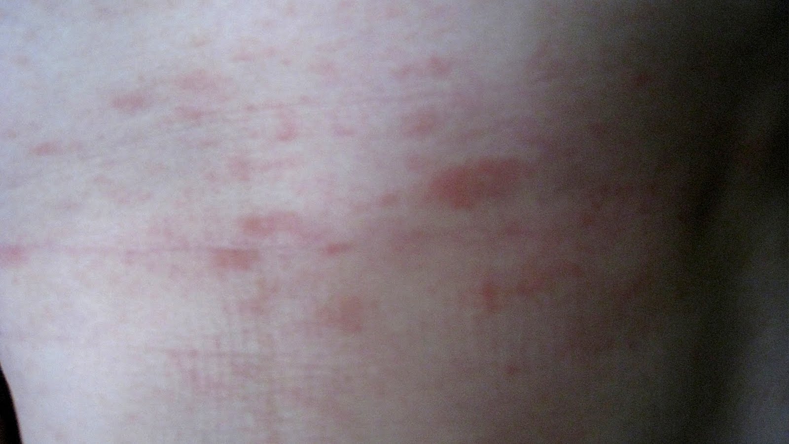 Humira Side Effects Rash - Effect Choices