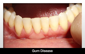 Bleeding Gums, Receding Gums and Loose Teeth