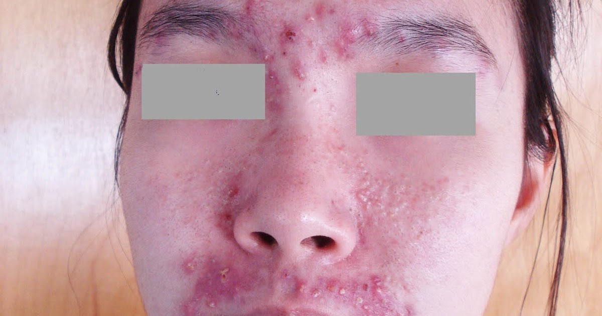 VIRTUAL GRAND ROUNDS IN DERMATOLOGY 2.0: Florid Acneiform Eruption