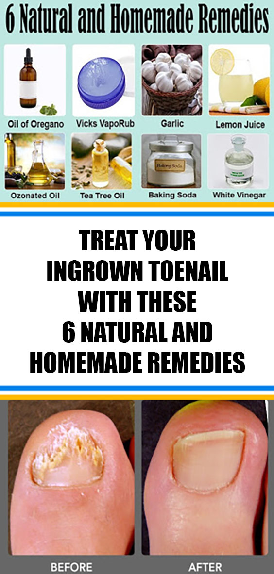 Treat Your Ingrown Toenail With These 6 Natural and Homemade Remedies ...