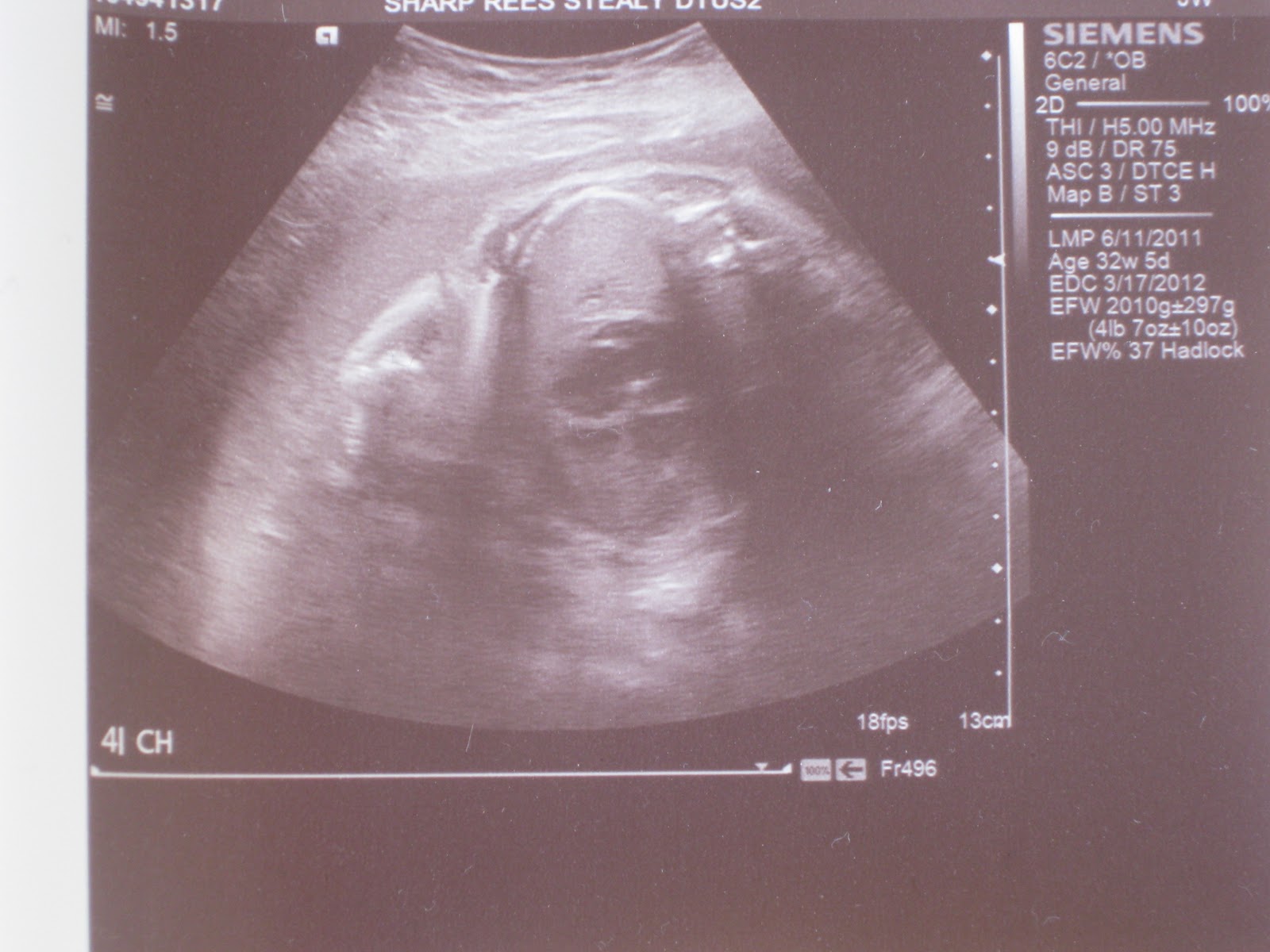 Baby Foley's Nine Month Chronicle: 32 Week Ultrasound