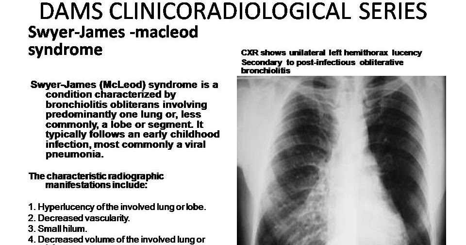 Swyer James Syndrome-Clinicoradiological Series - Radiology Imaging