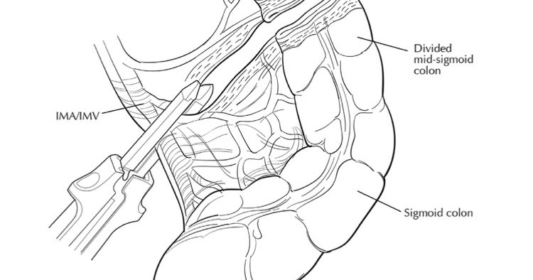 Radiotherapy Dictionary: Mesorectal fascia (MRF)