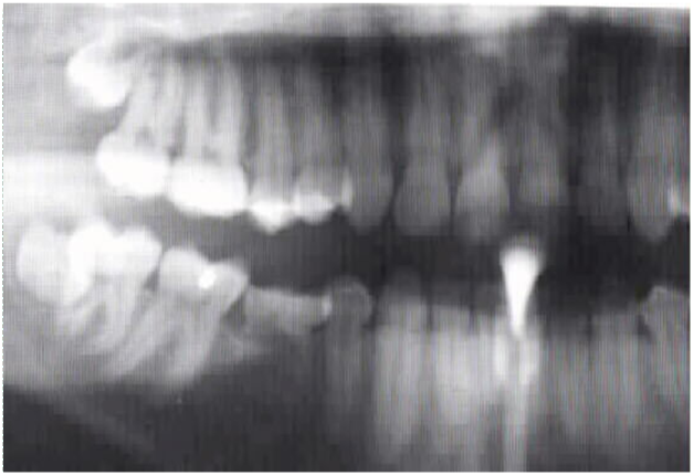Dentistry and Medicine: Surgical management of Unerupted and Impacted teeth