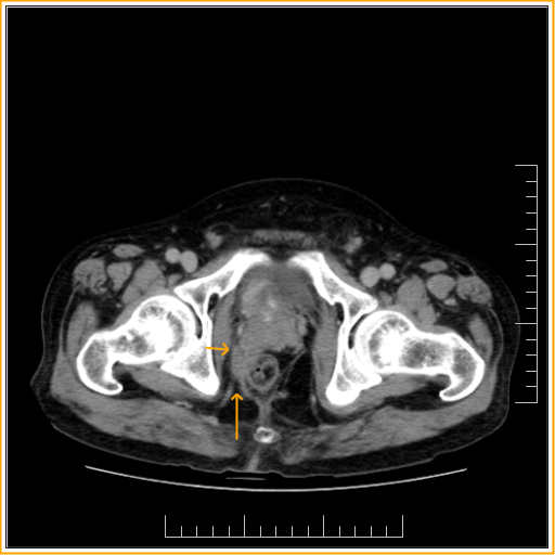 Suspected Prostatic Malignancy:CT - Sumer's Radiology Blog