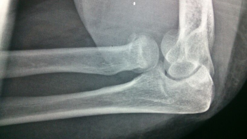 O R T O C R I T I C A: Fractura de cupula radial