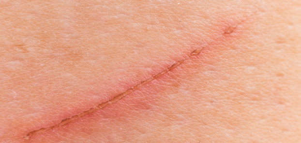 The way to eliminate scars naturally and with drug - Rajin Ikutan