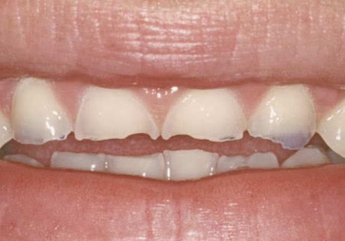 All About Dental Health: Tooth Erosion