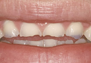 All About Dental Health: Tooth Erosion