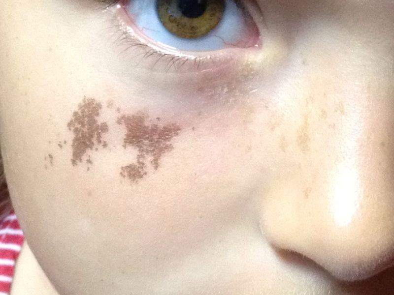 Revisiones_bibliográficas TyO_Web: Una mancha en la cara