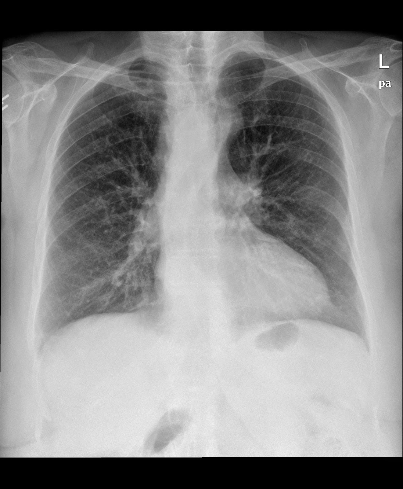 RADIOLOGIA LLEIDA: ARCO AORTICO DERECHO